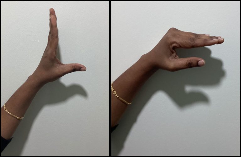 Easing Trigger Finger Pain - Ashford Medical